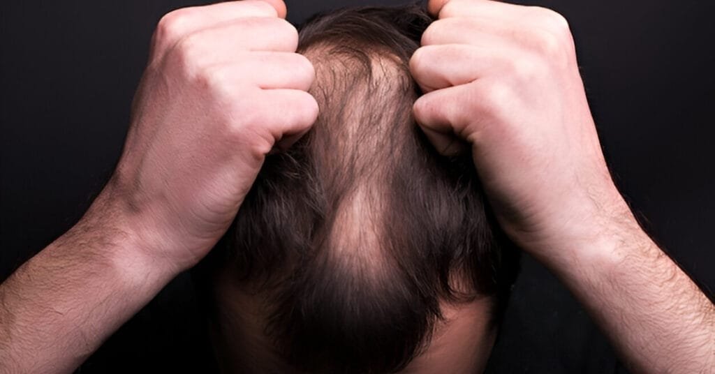 Jenis-Jenis Kebotakan dan Cara Mengatasinya Secara Medis - Eurasia Hair ...